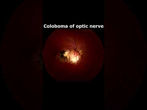 What diseases cause optic nerve damage