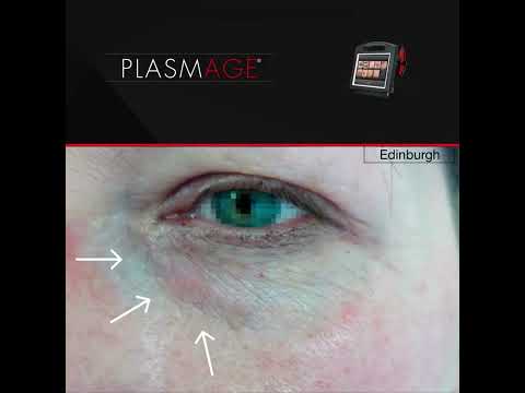 Remove Xanthelasma with Plasmage ® - such a simple and fast operation
