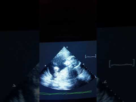 Alora Marie 19wks 3days