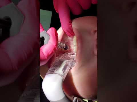 Watch a dental sealant being done. #shorts