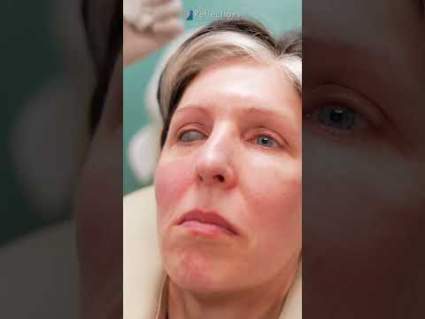 Long-pulsed YAG Laser for Blue Veins