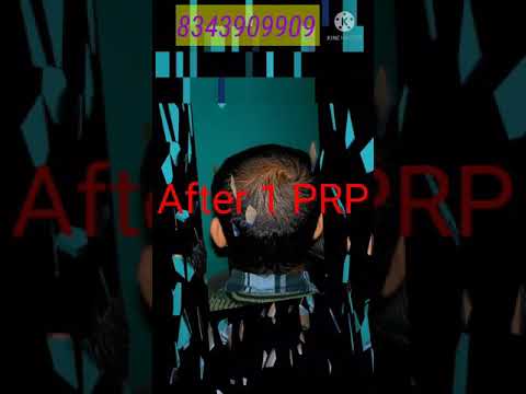 PRP Hair Loss Treatment Before and After | PRP results