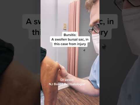 Have You Ever Heard of Bursitis?