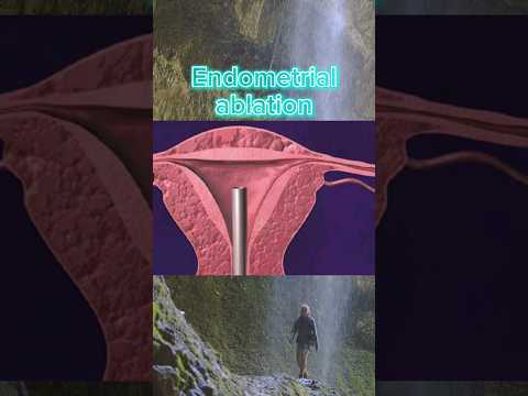 ENDOMETRIAL ABLATION | MEDICAL DEFINITION VOCABULARY TERMINOLOGY