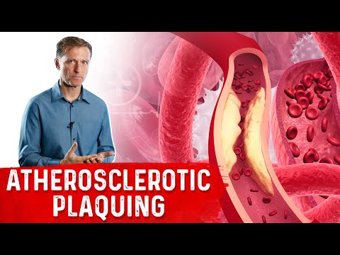 Protocol for Calcified Plaque in Your Arteries – Atherosclerosis – Dr.Berg
