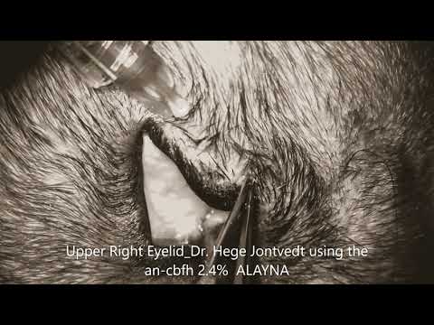 Upper Right Eyelid Dr Hege Jontvedt using the an cbfh 2 4% ALAYNA