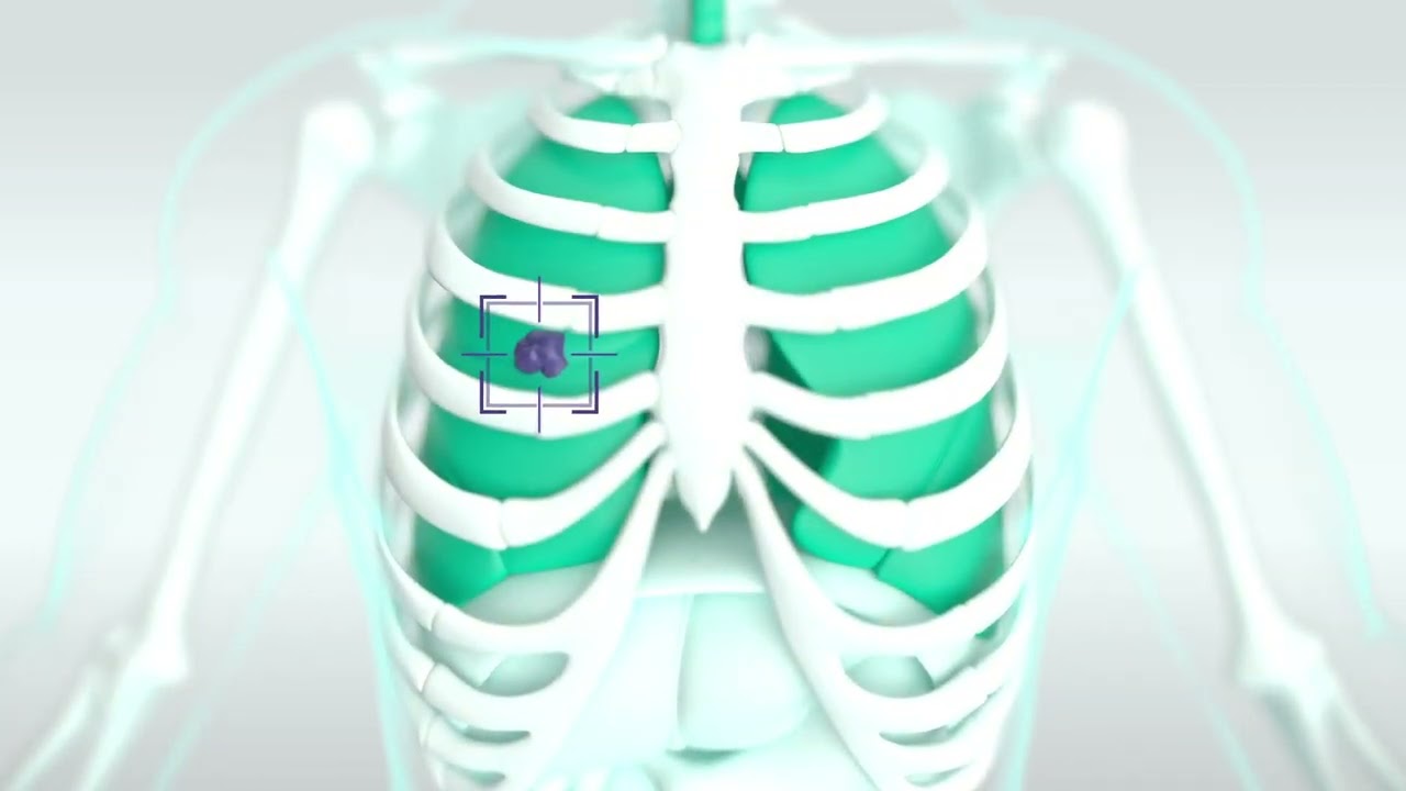 What is External Beam Radiation Therapy? | SERO