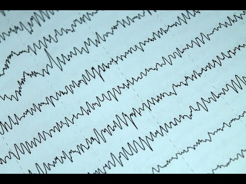 Electroconvulsive Therapy Explained