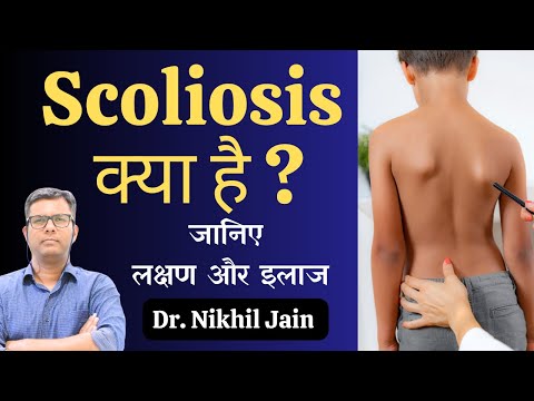 स्कोलियोसिस क्या है? What is Scoliosis? Explained in Detail | Symptoms (लक्षण ) and Treatment (इलाज)