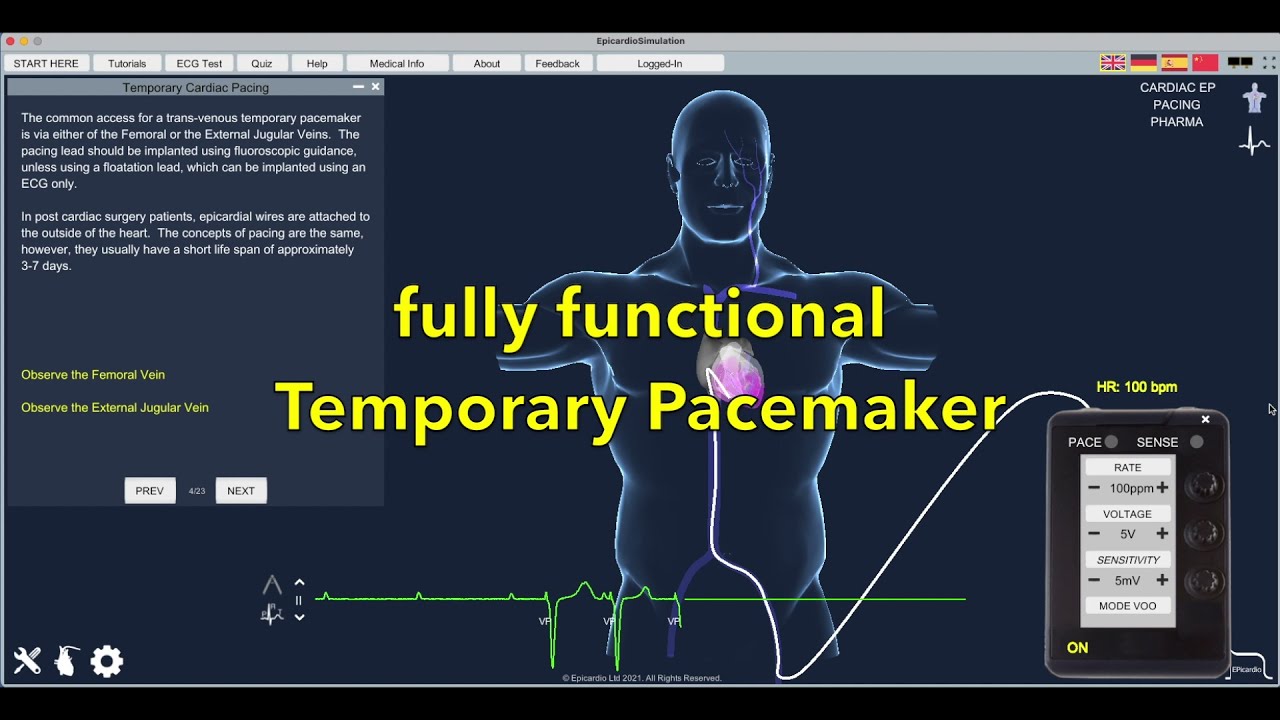 Epicardio Simulation™ Temporary Cardiac Pacing