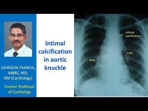 Intimal calcification in aortic knuckle X-ray chest PA