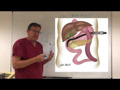 Options for biliary access in patients following Roux-en-Y Gastric Bypass (RYGB)