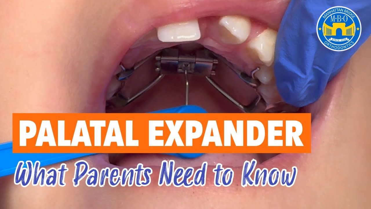 8 Things to Know About Palatal Expander