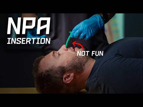 NPA Insertion (How To)