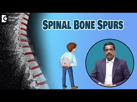 Spinal Bone Spurs - Symptoms & Treatment| Osteophytes - Dr. Kodlady Surendra Shetty| Doctors' Circle