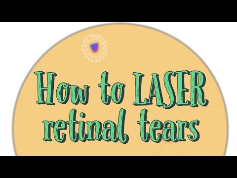 Retinal Tear Laser Surgery - COMPLETE GUIDE