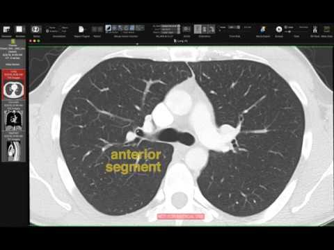Lobar and Segmental Lung Anatomy on CT- What the Radiologist should know