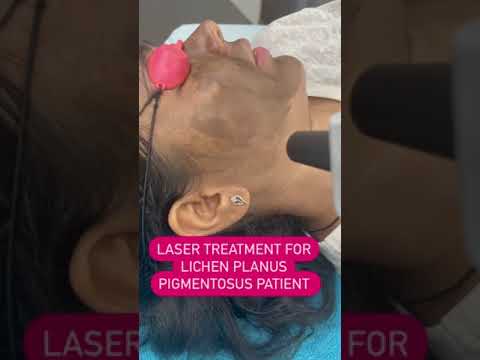 Laser treatment for lichen Planus Pigmentosus Treatment | Dr Ashima Goel|#shorts #youtubeshorts