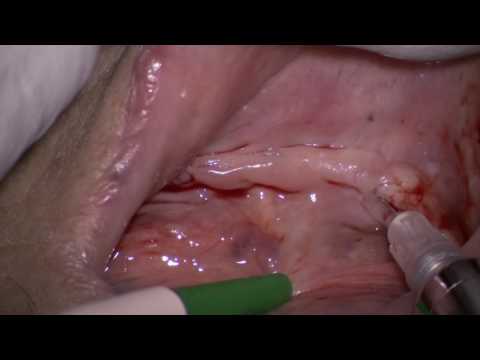 161011 Straumann implant reopening and Locator set in edentulous mandible
