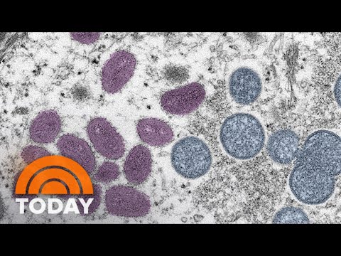 US Steps Up Efforts To Address Escalating Monkeypox Outbreak