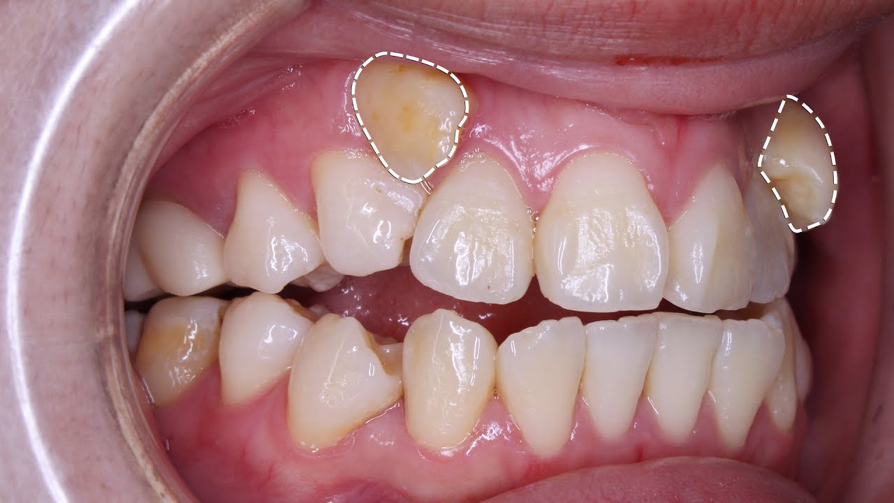 Braces Transformation: 28 Months to Straight Teeth