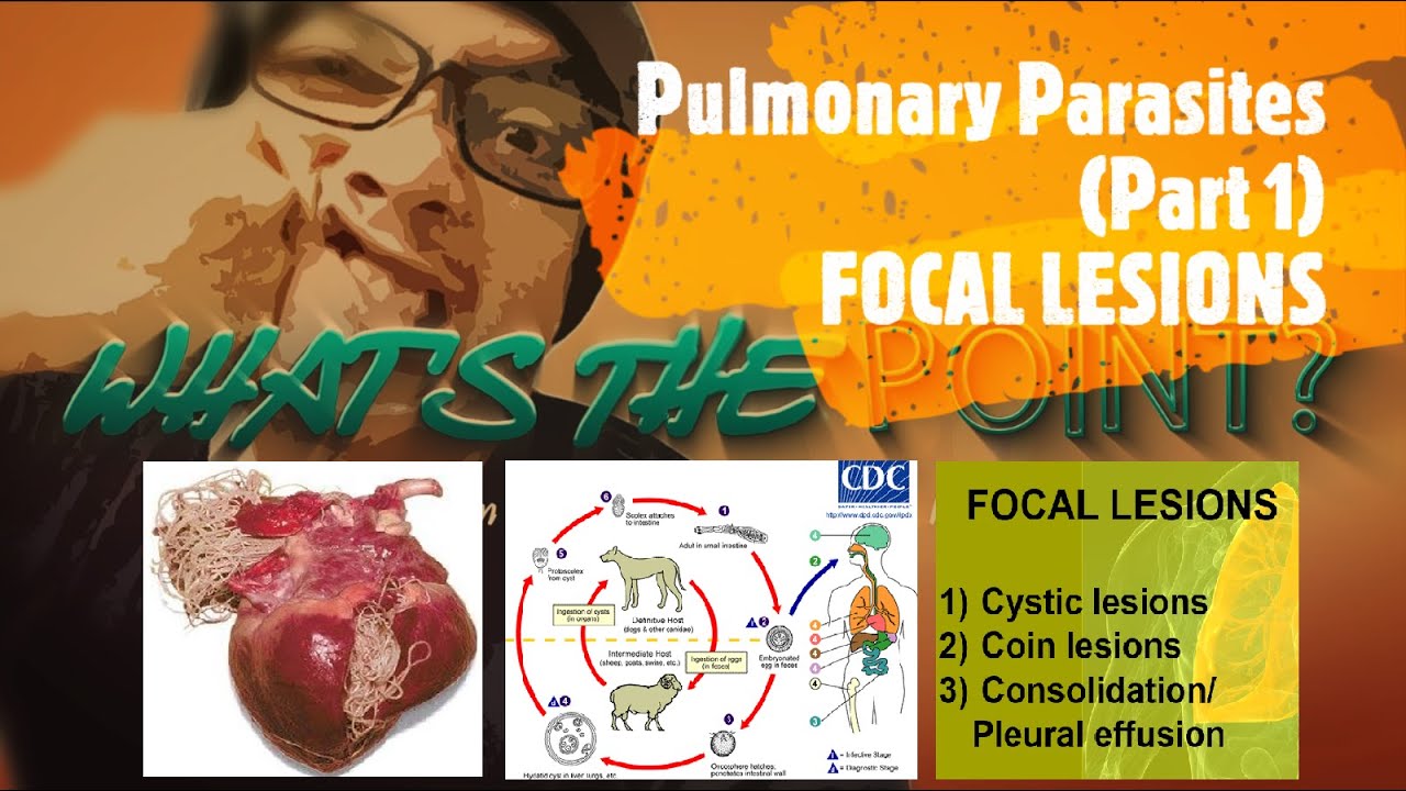 PULMONARY PARASITES (Part 1 of 3) - FOCAL LESIONS
