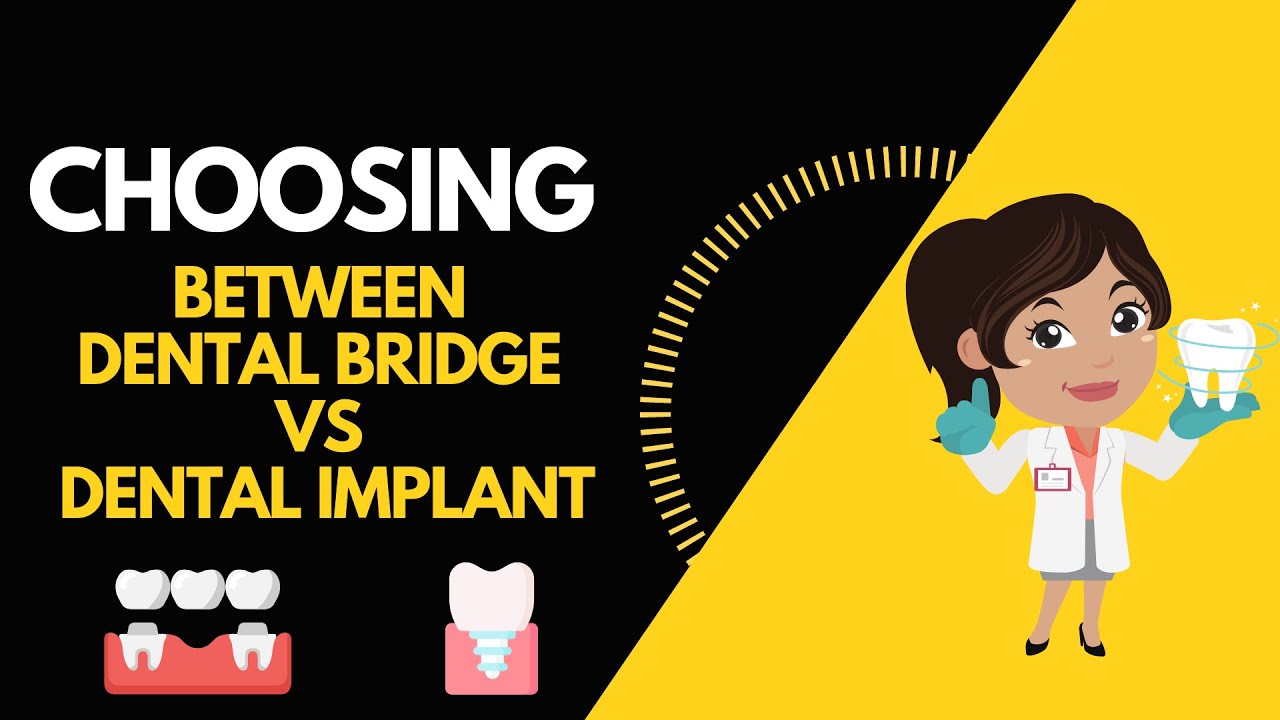 Choosing between dental bridge vs dental implant our guide | Dental House MI
