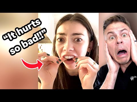 She Didn’t Wear Her Retainers For MONTHS… She Put Them In And THIS Happened | TheBentist