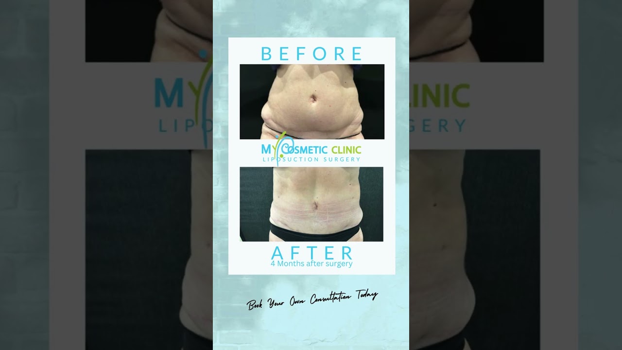 Stomach Liposuction Sydney - My Cosmetic Clinic