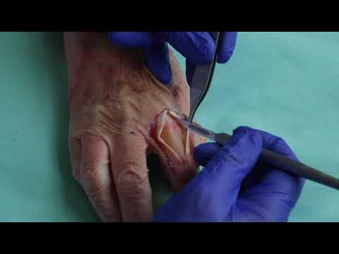 The Pulvertaft Approach to the proximal phalanx