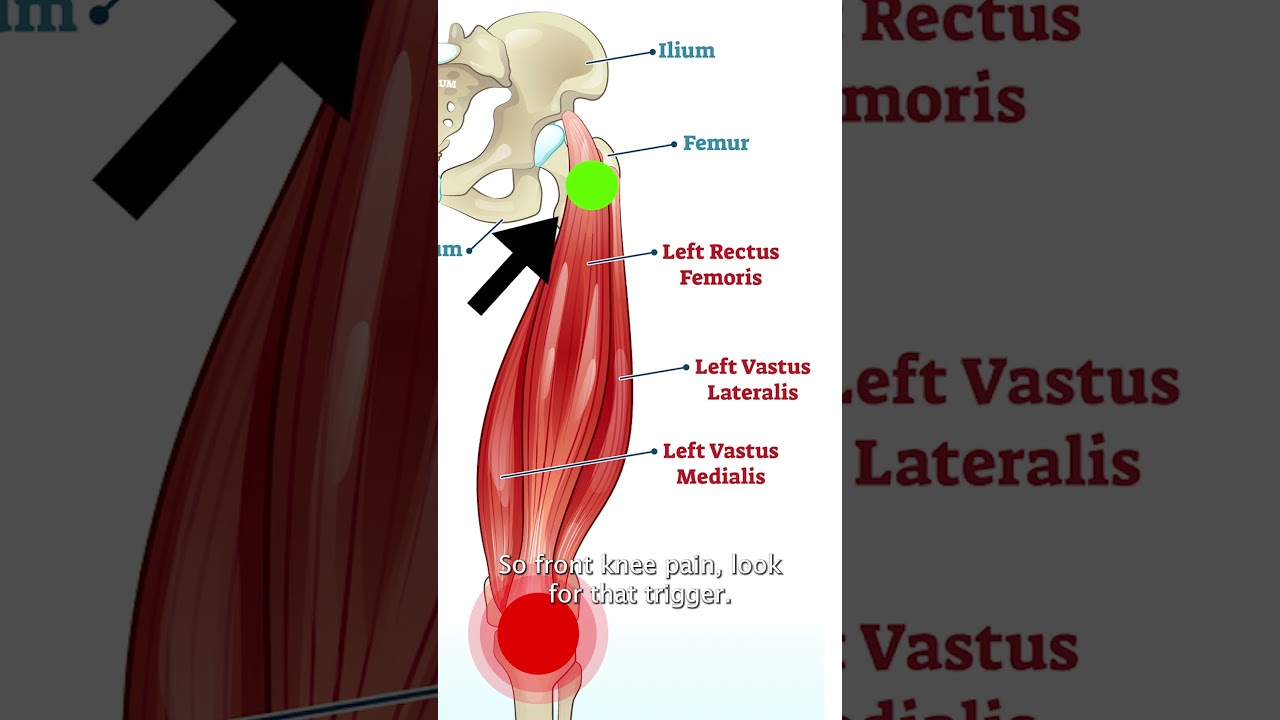 Trigger Point Overview Rectus Abdominis Trigger Point - vrogue.co Trigger Point Overview Rectus Abdominis Trigger Point - vrogue.co