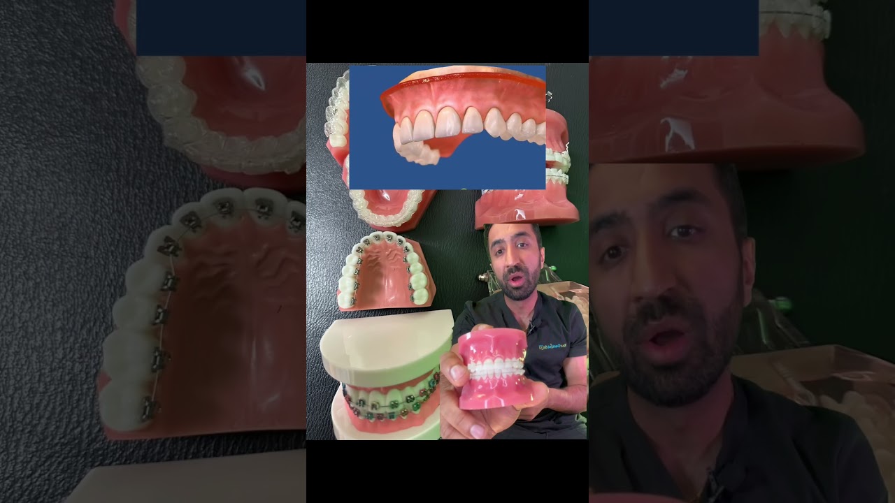 5 Ways To Straighten Your Teeth #braces #invisalign