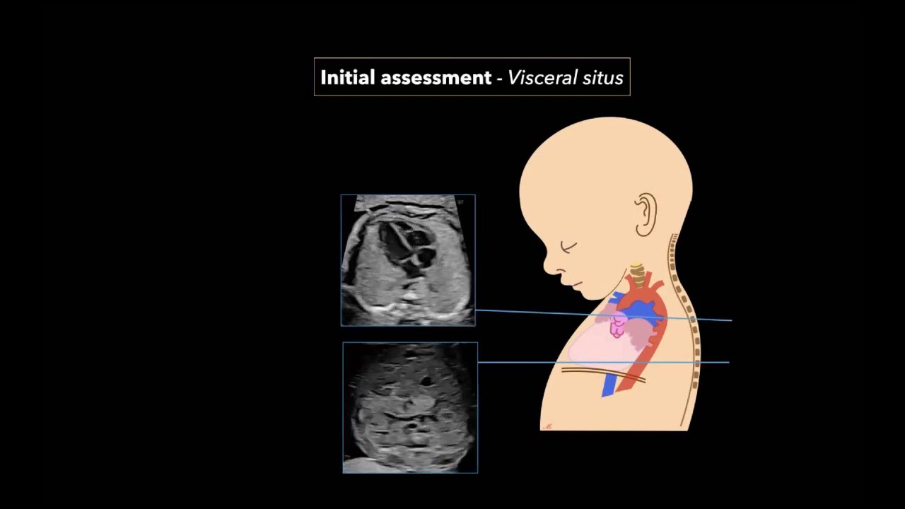 Fetal Echocardiography: Protocol and Technique