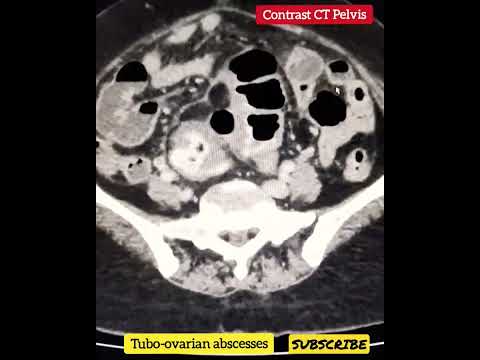 Tubo-ovarian abscesses - Radiology