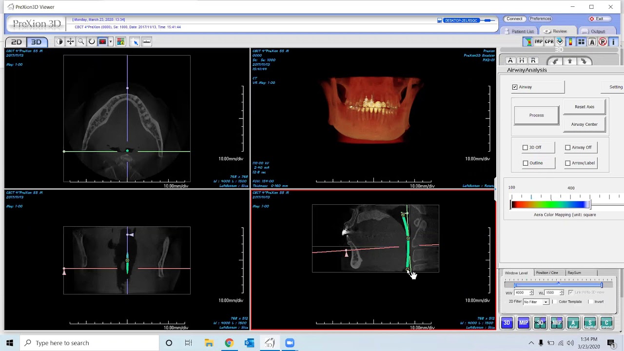 PreXion Training Tips: Airway Analysis