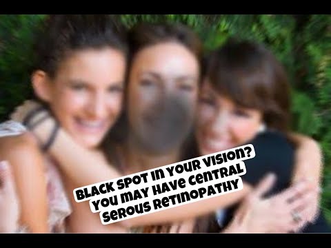 What is Central Serous Retinopathy/CSR #CSR