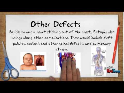 Ectopia Cordis