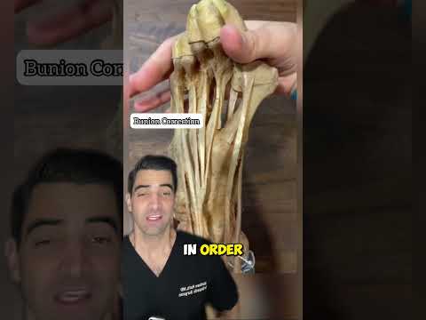 Bunion Correction