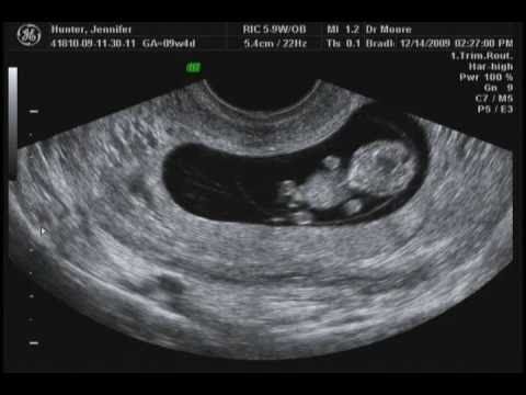 Case 169 : First Trimester of Pregnancy