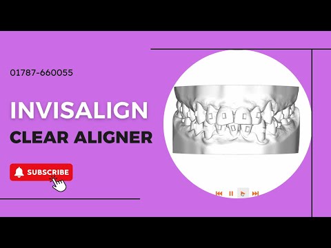 Invisalign clear aligner | Digital Planning