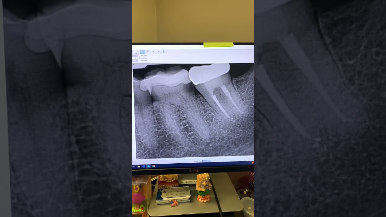 RCT of #19 using E-FLEX S files by Eighteeth. 