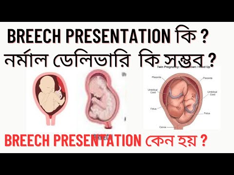 Breech presentation in pregnancy || Normal delivery in Breech presentation || Smart Mamoni||