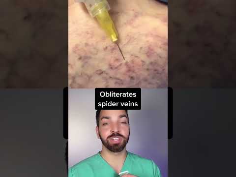 Sclerotherapy