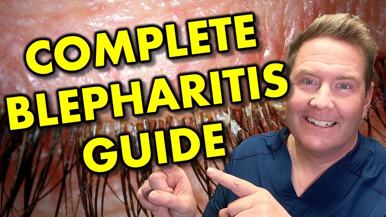 Everything about Blepharitis Types, Symptoms & Treatment