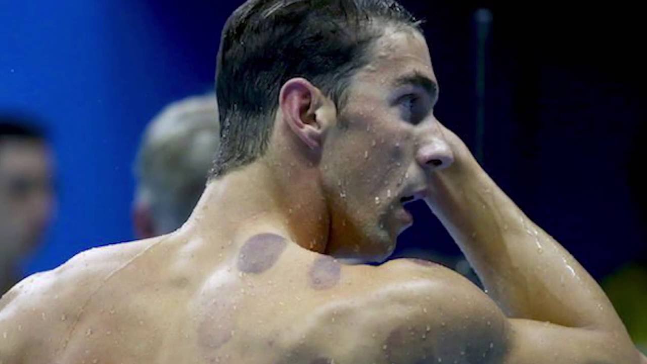 Cupping - How Does It Work?