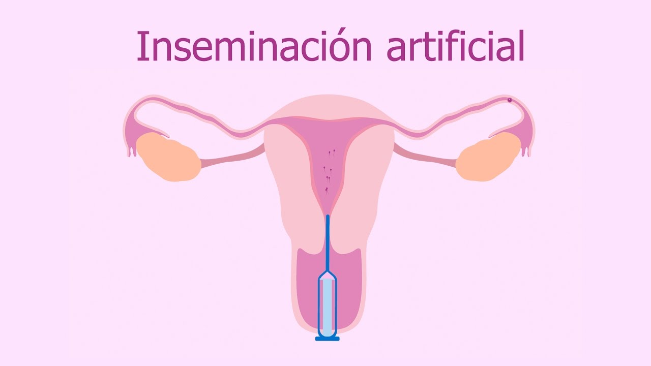 Inseminación artificial