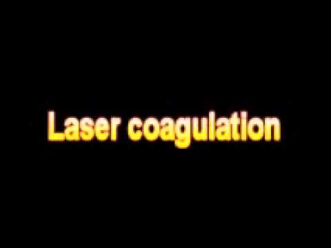 What Is The Definition Of Laser coagulation - Medical Dictionary Free Online Terms