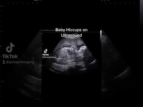 Baby Hiccups on Ultrasound #jerbearimaging #ultrasound #hiccups #baby #electiveultrasound