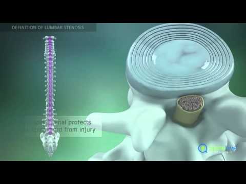 Lumbar Stenosis. Definition