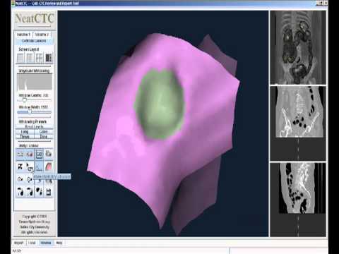 NeatCTC: A Fully Automatic CAD-CTC System